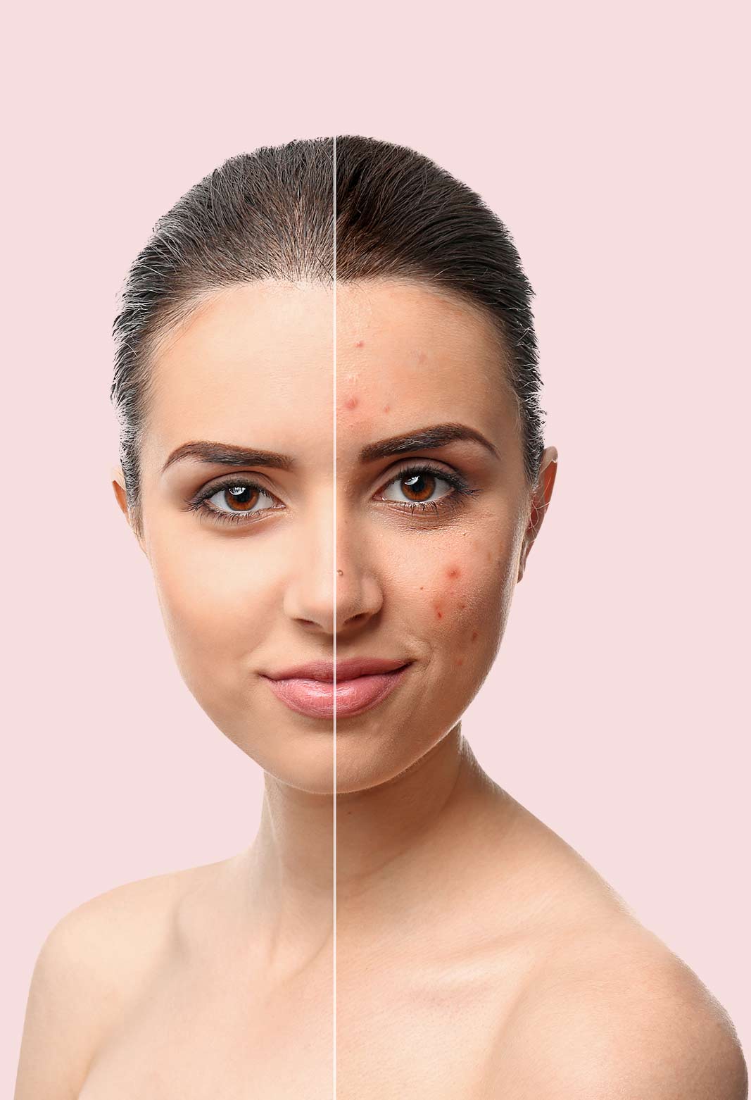 Cortisone Shot For Acne Treatments | Beverly Hills Med Spa
